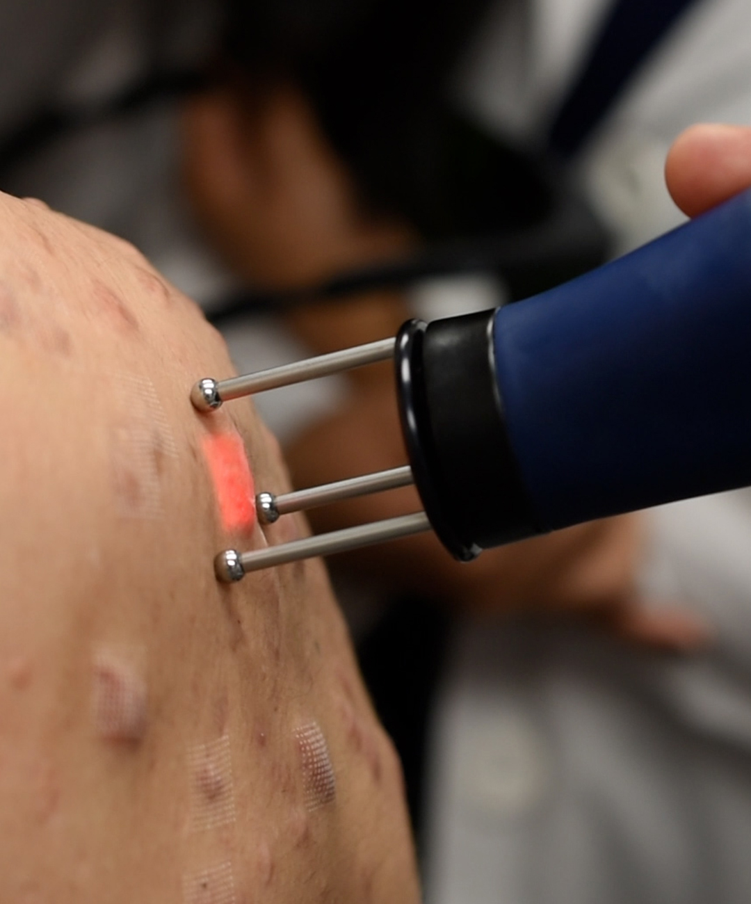 Tratamiento de Cicatrices Queloides | Dermika